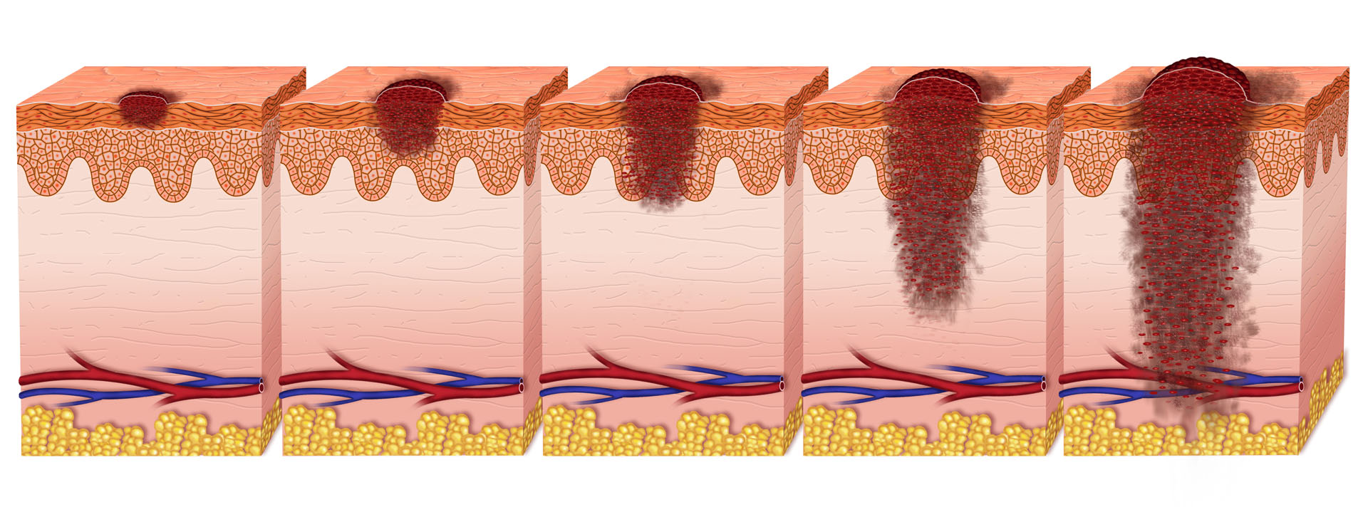 Melanoma - CBD Skin Cancer Clinic